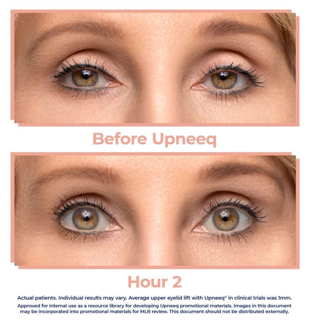 Upneeq Eyelid Lifts - NEW! • Luxura Med Spa Chicago